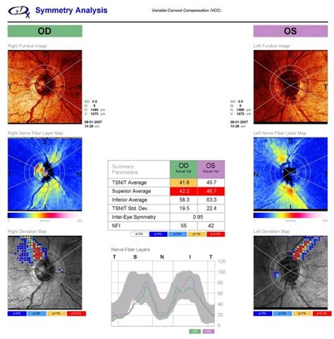 Glaucoma Detection Using Retinal Nerve Fiber Layer Optical Texture Analysis Review Of