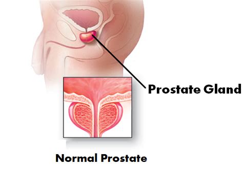 Stage 4 Prostate Cancer Treatment In Delhi Metastatic Prostate Cancer