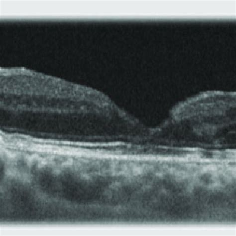 Postoperative Macular Optical Coherence Tomography With Horizontal