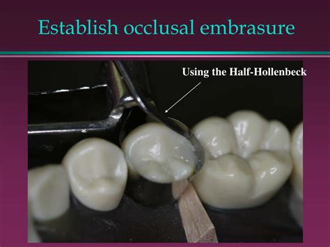 Ppt Class I And Ii Composite Restorations Principles And Techniques