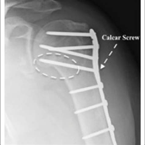 Pdf Proximal Humerus Fractures Evaluation And Management In The Elderly Patient