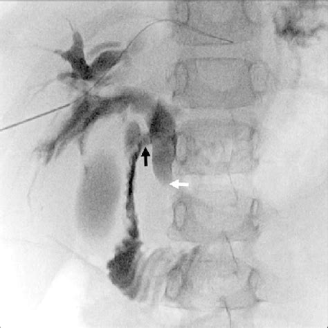 Percutaneous Transhepatic Cholangiography Shows A Distal Cbd Download Scientific Diagram