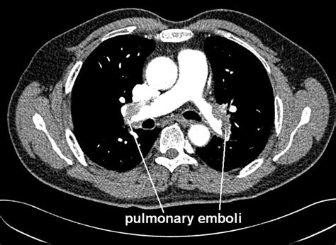 Massaging The Outcome An Unusual Presentation Of Pulmonary Embolism