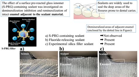Effect Of Surface Pre Reacted Glass Ionomer Containing Dental Sealant
