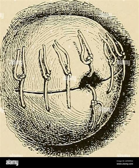 Cervix Excision Hi Res Stock Photography And Images Alamy