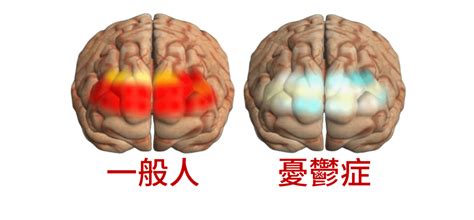 憂鬱症評估與治療新利器 結合近紅外光腦光譜檢測、顱刺激治療效果看得見 新頭條 Thehubnews