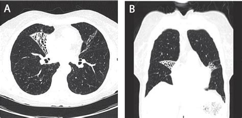 Nodular Bronchiectatic Form Of Nontuberculous Mycobacterial Lung Download Scientific Diagram