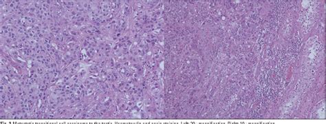 Figure 2 From A Rare Case Of Testicular Metastasis Of Bladder