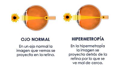 Hipermetropía SOF Clínica Oftafmológica