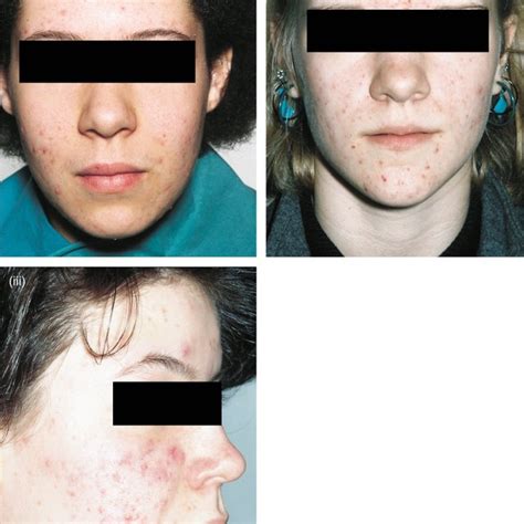 Acne Grading Scale I Mild Ii Moderate And Iii Severe Download