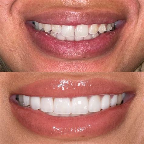 Smilemakeover Veneers Cosmeticdentistry Passionfordentistry