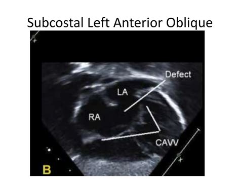 Asd Echo Assessment Renewed Slideshow Pptx