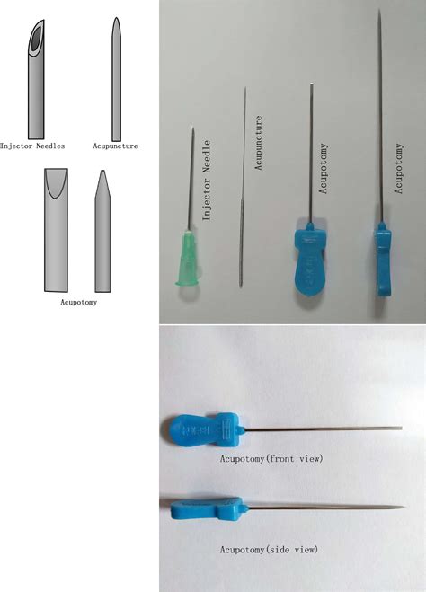 Figure 1 From Percutaneous Release Of The First Extensor Tendon Compartment In De Quervains