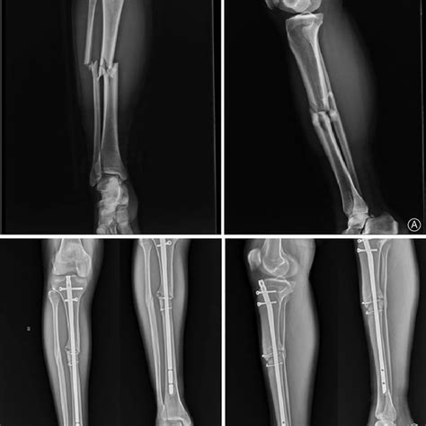 Two Years After The Third Operation The Right Tibial Fracture Remained Download Scientific