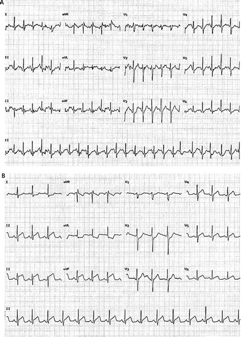 Asymptomatic St Segment Elevation In The Recovery Phase Of The Exercise