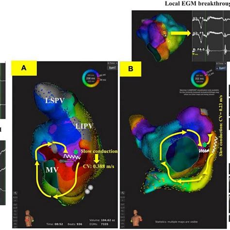Ultra High Density Mapping During Perimitral Afl In A Patient With