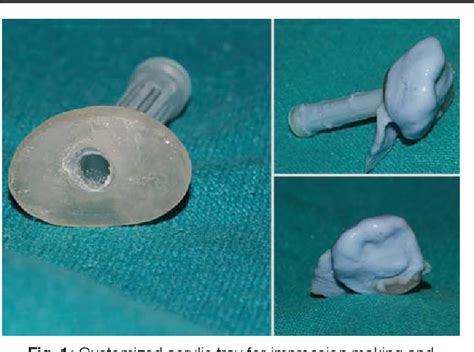 Figure From Customized Liquid Ocular Prosthesis For Anophthalmic