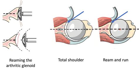 Uw Shoulder And Elbow Academy Support Shoulder Education And Research