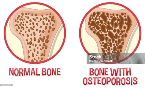 Comparison Of Normal Bone And Bone With Osteoporosis Stock Illustration