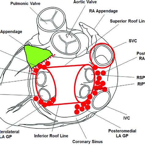 Hybrid Procedure With Ablation Lesions Gp Ganglionated Plexus Ivc