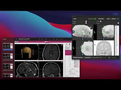 Mne Python Intracranial Electrode Location Tutorial Youtube