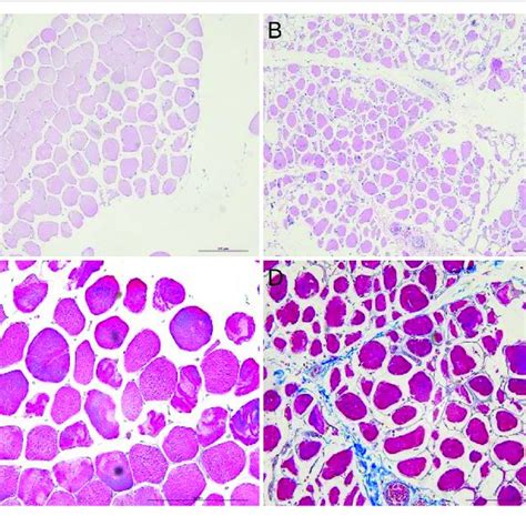 He And Massons Trichrome Staining Showing Atrophy Of Human