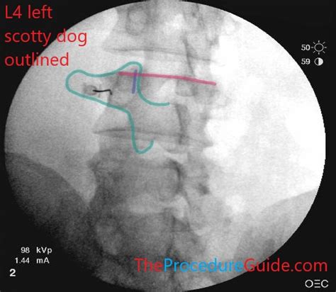 Fluoroscopic Guided Sacroiliac Sij Joint Dorsal Ramus And Lateral