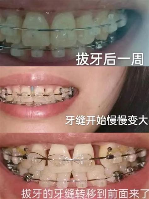 正畸失败真实反馈，正畸人“进来学习 知乎