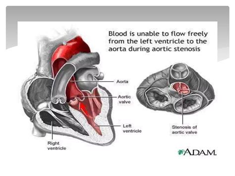 Aortic Regurgitation And Stenosis Sushila Ppt