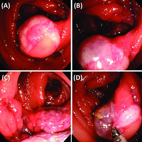 Figure3 The Intussusception Is Successfully Reduced By Colonoscopy With Download Scientific