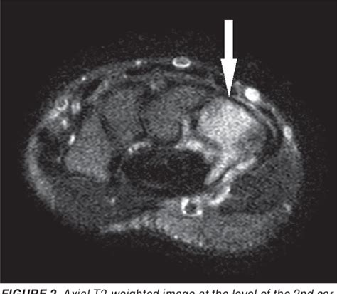 Hook Of The Hamate Fracture Semantic Scholar
