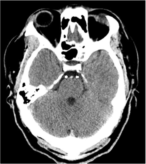 Non Contrast Ct Scan With Hyperdense Basilar Artery Sign Arrows No