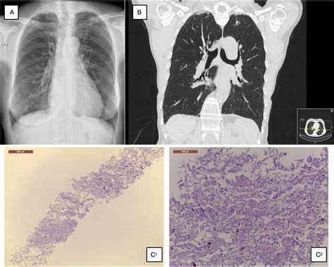 Pleuroparenchymal Fibroelastosis As Another Potential Lung Toxicity