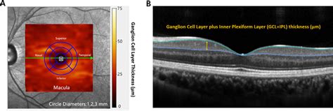 Oct Imaging In This Study A Sectoral Heat Map Of The Gcl Thickness
