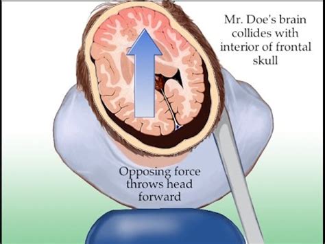 Mechanism Of Axonal Shearing YouTube