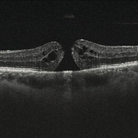 Full Thickness Macular Hole Oct Cross Sectional Image Download