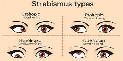 Symptoms Of Eye Misalignment Strabismus Cross Eyed Signs