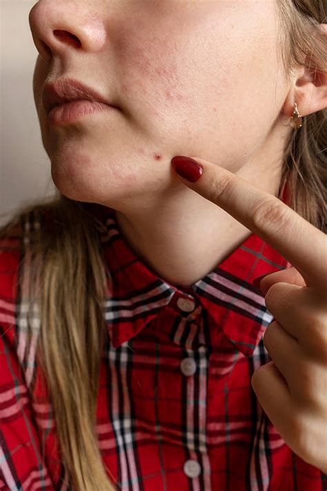 June Is Acne Awareness Month Essential Tips For Effective Acne