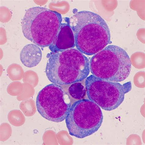 Hydroxyurea Induced Ulcers On The Leg Of A 73 Year Old Man With Chronic
