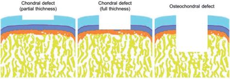 Biomimetic Biphasic Scaffolds For Osteochondral Defect Repair Pmc