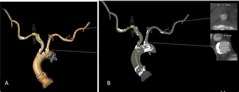 Computed Tomography Images In Preparation For A Transaxillary Tavi