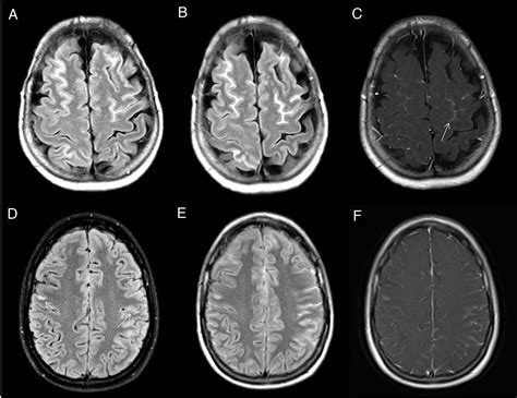 Flair Hyperintensity In The Subarachnoid Space Main Differentials