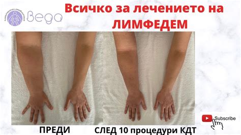 Всичко за лечението на Лимфедем Въпроси и Отговори на пациенти