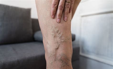 What Is Peripheral Artery Disease