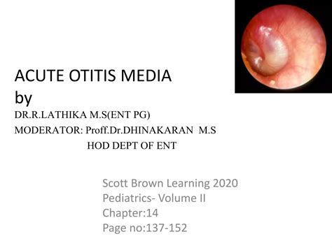 Acute Otitis Media Final Pptx