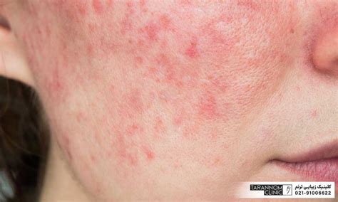بهترین راه درمان رزاسه از علل تا تشخیص
