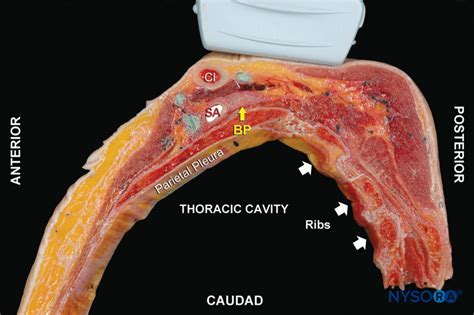 Ultrasound Guided Supraclavicular Brachial Plexus Nerve Block Nysora