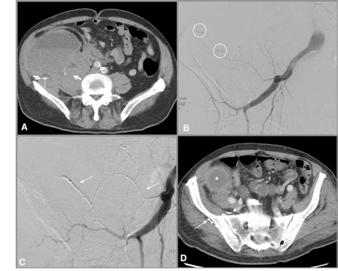 Case 6 A Mdct Haematoma In The Right Iliopsoas With Active Bleeding Download Scientific
