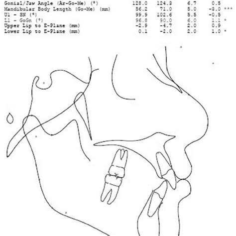 Lateral Cephalometric Analysis Download Scientific Diagram