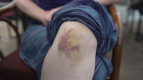 Bruised Knees Artofit